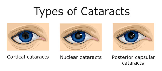 Posterior Subcapsular Cataracts: Causes, Symptoms, and Solutions