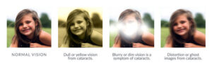 Cortical Cataracts: Causes, Symptoms & Vision Buddy’s Assistive Technology